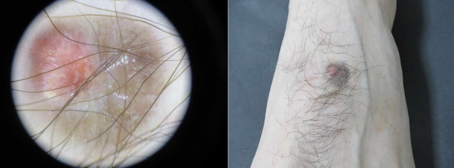 Carcinoma Anexial Microquístico - Lugones Editorial