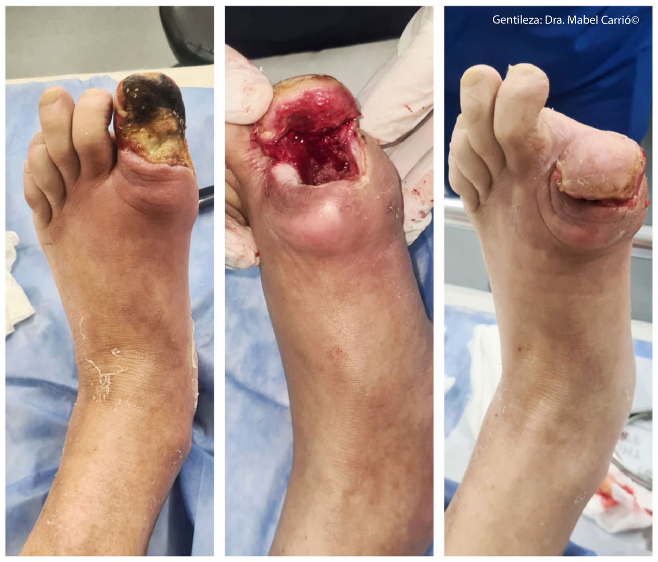 Abordaje Y Tratamiento Del Pie Diabético - Lugones Editorial