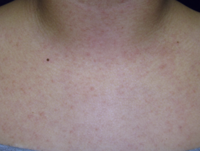 Manifestaciones Cutáneas Del Dengue - Lugones Editorial